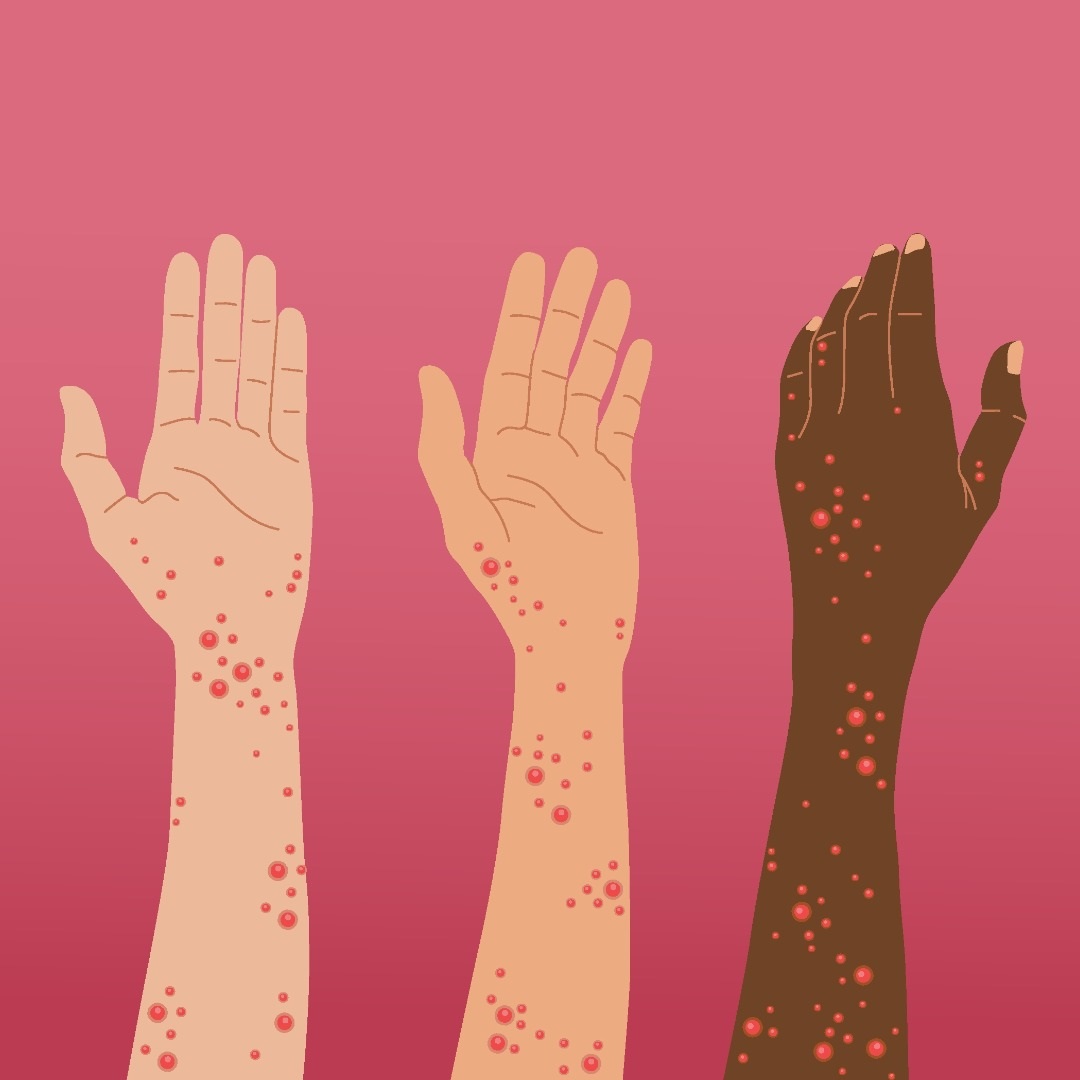 Een jaar apenpokken: een terugblik | çavaria